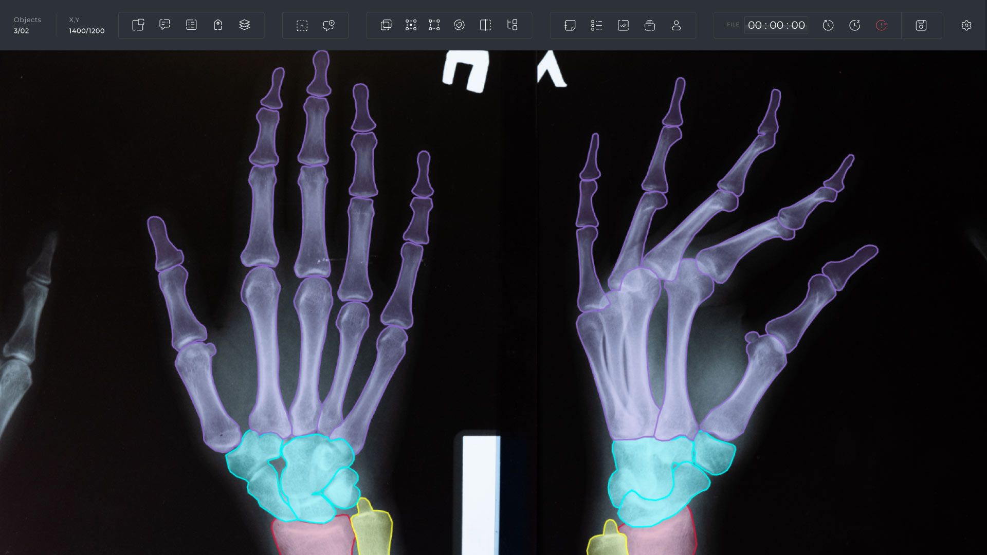 3 main labeling tools for medical projects | Keylabs
